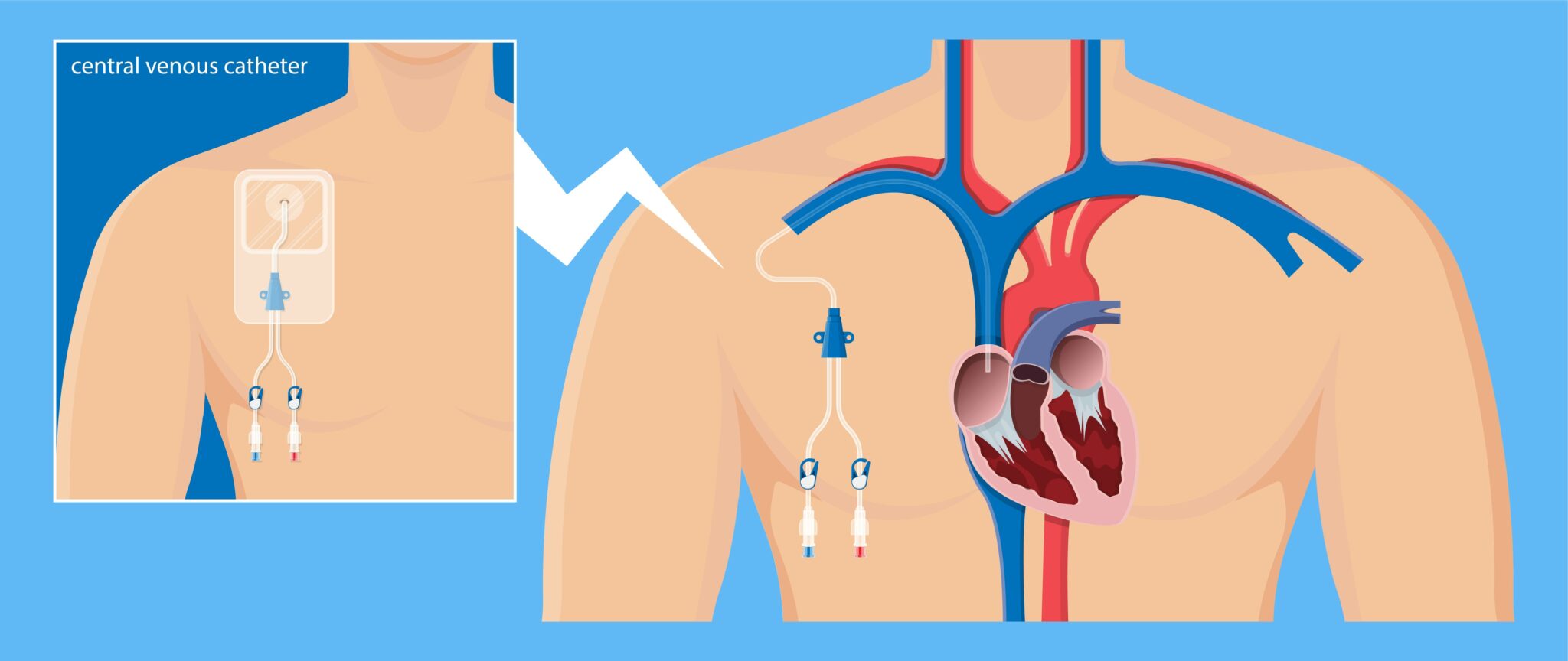 central venous catheter CVC PICC line peripherally inserted access large vein medication fluid ...